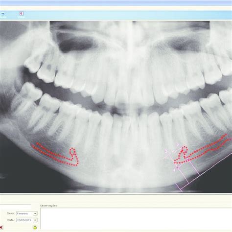Incisive Foramen Radiograph