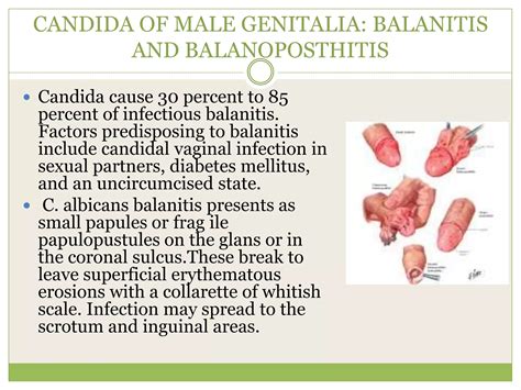 Candidiasis Pptx