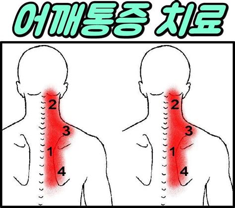 어깨가 심상치 않다 뒷목통증 어깨통증 등통증 날개죽지통증 통증이 퍼지는데 이거 뭐지 뒷목 어깨 등이 승모근근육 이라는 사실 알고 계신가요 이럴 때 나 혹시