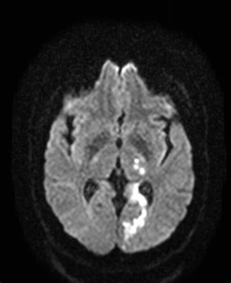 Brown Hospital Medicine On Twitter A 50 Year Old Woman Presented With