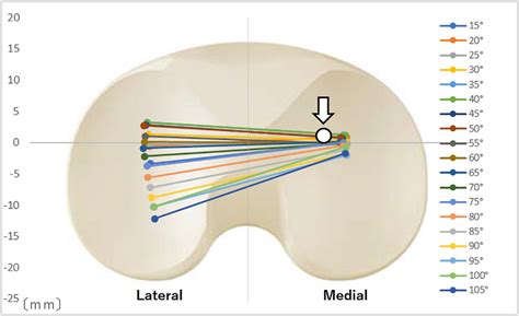The Lines Indicate The Femoral Condylar Axis Relative To The Tibia At Download Scientific