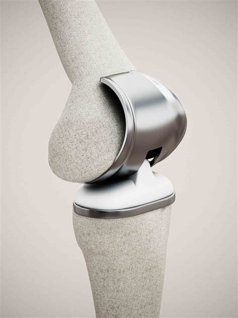 การผาตดเปลยนขอเขาเทยมทงหมด Total Knee Arthroplasty TKA