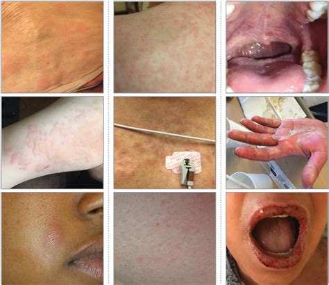 Beta Lactam Allergy And Cross Reactivity Recapem