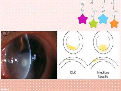 Diffuse Lamellar Keratitis Dlk Ppt