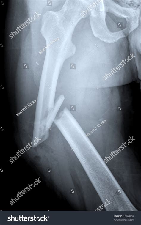 X Ray Leg