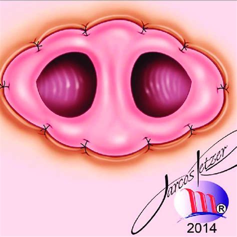 The Colostomy Was Fixed By Stitching The Anterior Colonic Wall To The Download Scientific