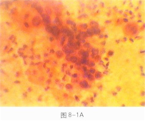 外阴早期浸润性鳞癌 搜狗百科
