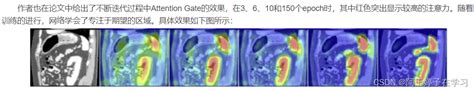 Attention Unetattentionunet Csdn博客