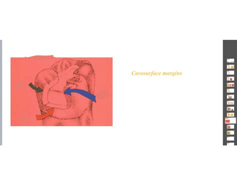 Class Ii Cavosurface Margins Quiz