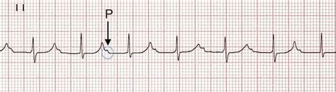 First Degree Heart Block LITFL ECG Library Diagnosis