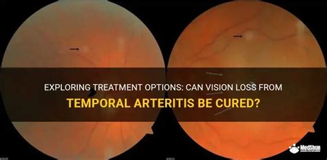Exploring Treatment Options Can Vision Loss From Temporal Arteritis Be