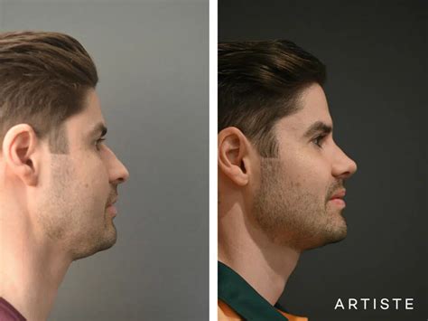 Male Rhinoplasty Gallery Artiste Plastic Surgery