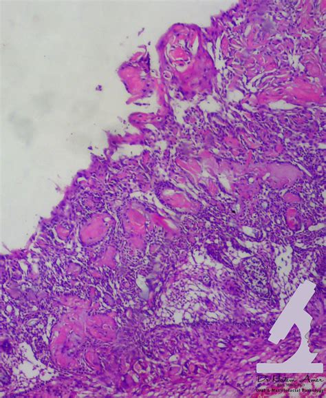 A Case Of Calcifying Odontogenic Cyst Gorlin Cyst Arising In The