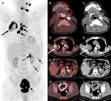 Pulmonary Sarcomatoid Carcinoma With Epiglottis And Ileum Me