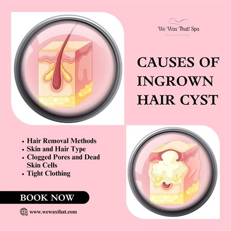 Ingrown Hair Cyst Removal