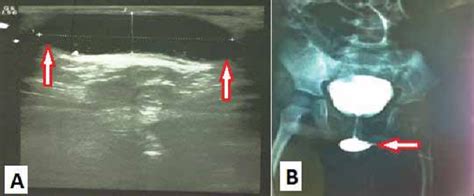 A Us Demonstrated An Inhomogeneous Hypoechogenic Hypovascular