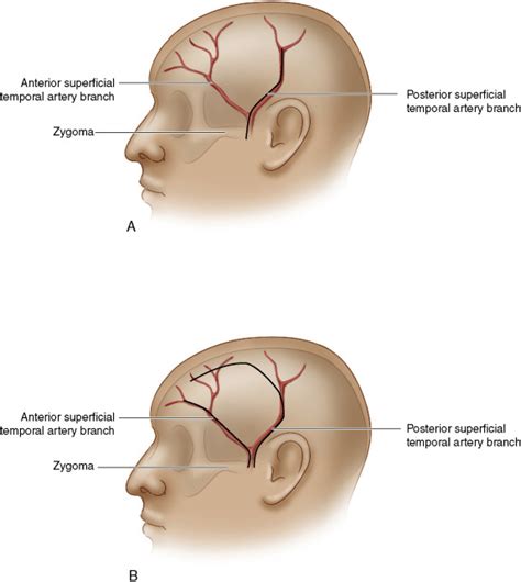 Superficial Temporal Arterymiddle Cerebral Artery Bypass Neupsy Key