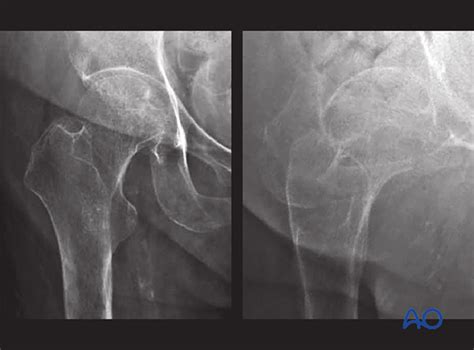 Assessment Of Patients With A Proximal Femoral Fracture