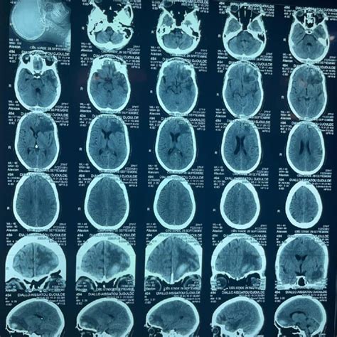 Cerebral Computed Tomography Revealed A Focal Point Of Intraparenchymal