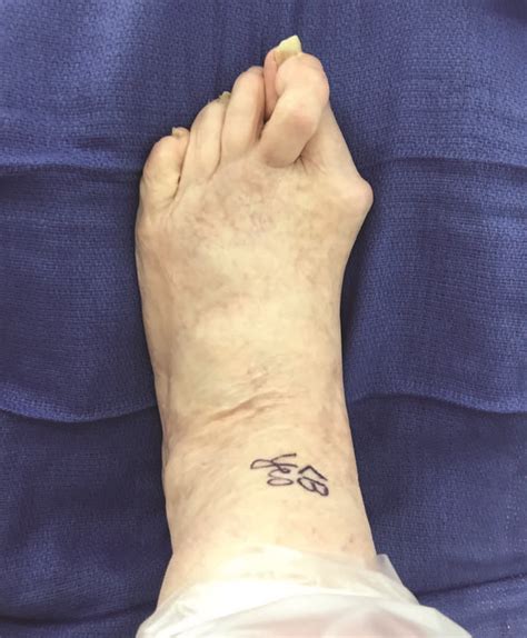 Plantar Plate Tears Dr Babajide A Ogunlana Dpm Facfas Wes
