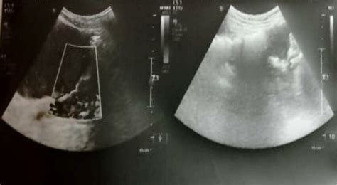 Ultrasonogram Showing Hepatosplenomegaly Download Scientific Diagram