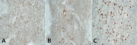 Immunohistochemical Stains Of The Pdtc Revealed A Diffuse Positivity