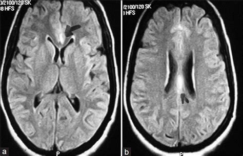 Axial T1 Weighted Image Showing The Bleed In The Interhemispheric