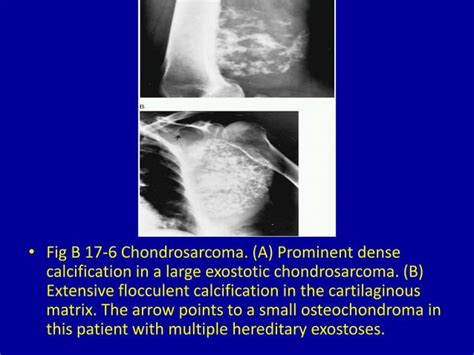 17 Localized Calcification Or Ossification In Muscles And Ppt Free Download