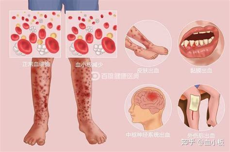血小板减少会有哪些表现？ 知乎