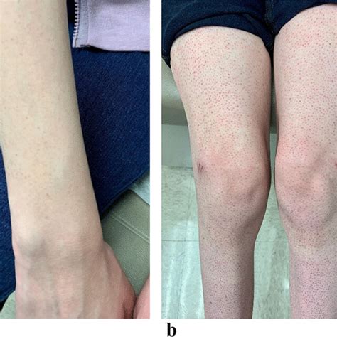 Photos Of The Patients Perifollicular Petechial Hemorrhagic Rash With Download Scientific Photos Of The Patients Perifollicular Petechial Hemorrhagic Rash With Download Scientific