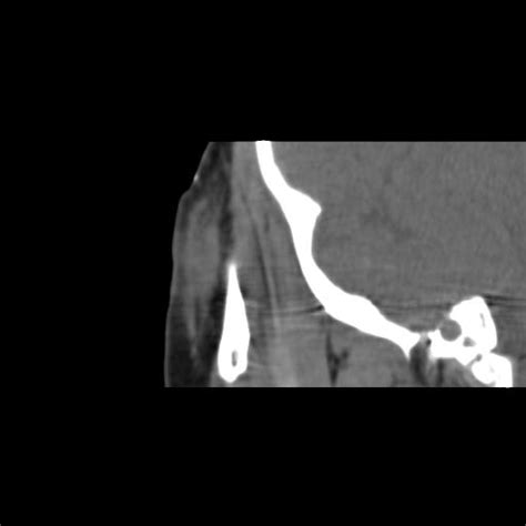 Fileorbital Blow Out Fracture Ocular Lens Dislocation And