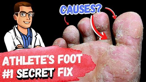How To Cure Athletes Foot Fungus Fast Home Remedies 3 Big Secrets