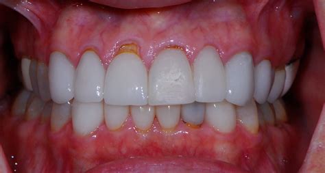 Healthy Lower Gums