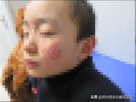 白癜風患者真實案例分析兒童白癜風治療前後對比圖症狀需分清 每日頭條
