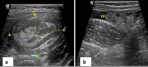 Figure 2 From Ultrasound Guided Hydrostatic Reduction Of Intussusception Using Saline Enema In
