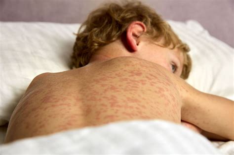 La Denuncia DellOMS La Minaccia Del Morbillo Sta Tornando Per La