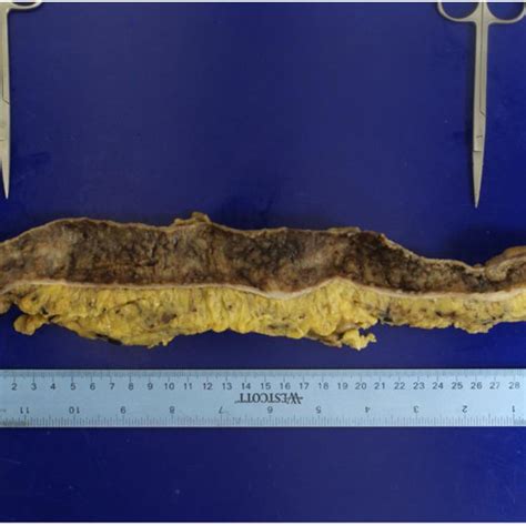 Colonic Stricture In Colonoscopy With Ulcerated Mucosa Spontaneous