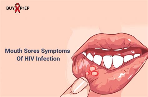 Mouth Sores Symptoms Of Hiv Infection Buy Prep