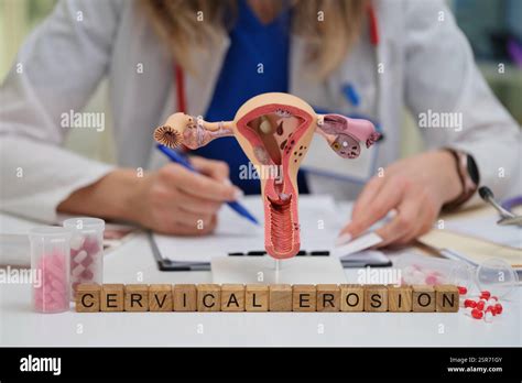 A Comprehensive Understanding Of Cervical Erosion Medical Insights And Educational Resources