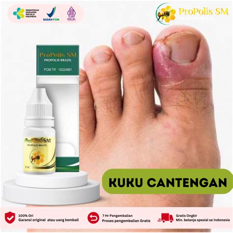 Obat Kuku Cantengan Obat Kuku Rusak Berjamur Obat Jamur Kuku Kaki