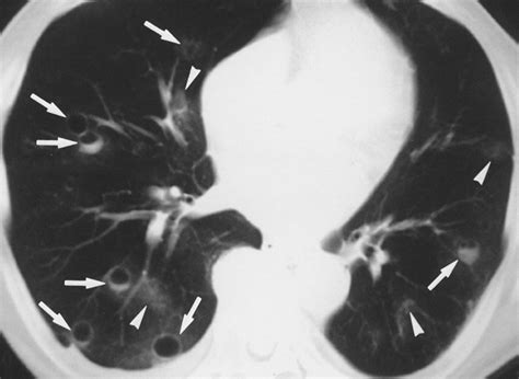 Metastatic Angiosarcoma Of The Lung Spectrum Of Ct Findings Ajr