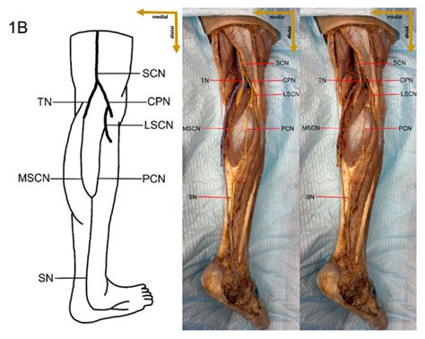 Anatomical Variations In The Formation Of The Sural Nerve A Pilot