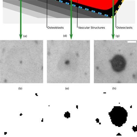 Illustration Of Remodelling In Cortical Bone With Magnified View In