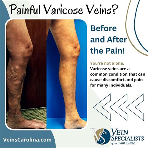 Varicose Veins In Hands