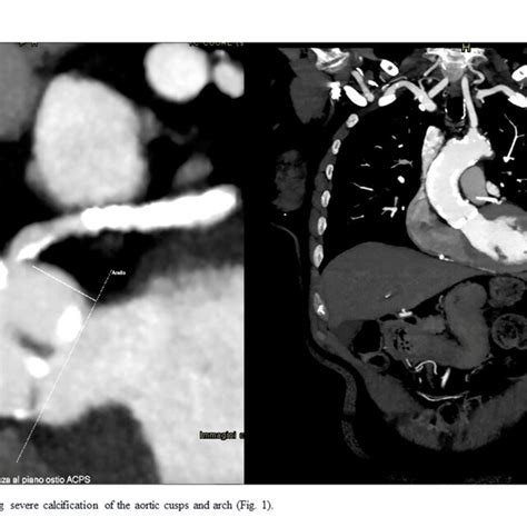 Proposed Standardized Definitions Of Aortic Valve Cusp Symmetry A And