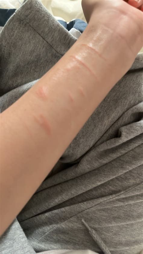 긁힌 상처 같이 보이나요 지식in