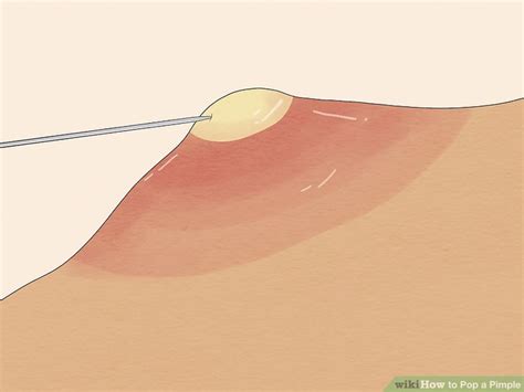 Simple Ways To Pop A Pimple WikiHow