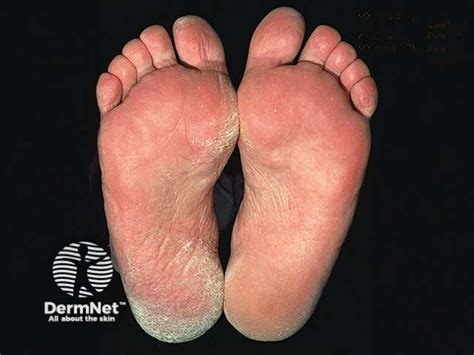 Fungo Tinea Pedis Tinea Pedis Over 293 Royalty Free Licensable Stock