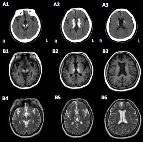Figure2findings Of Brain Ct And Mri A The Brain Ct Scan Reveals High