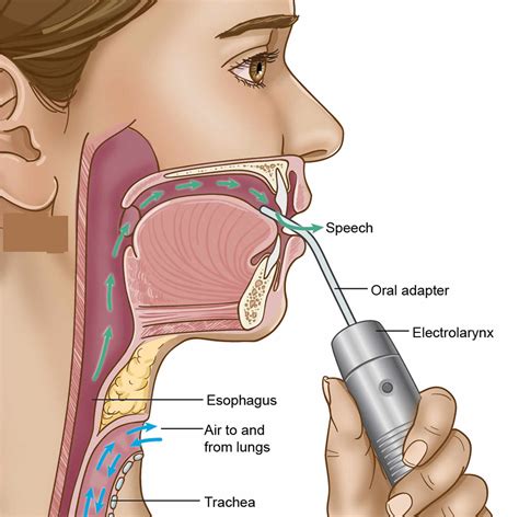 Total Or Partial Laryngectomy Procedure Complications Risks And Recovery